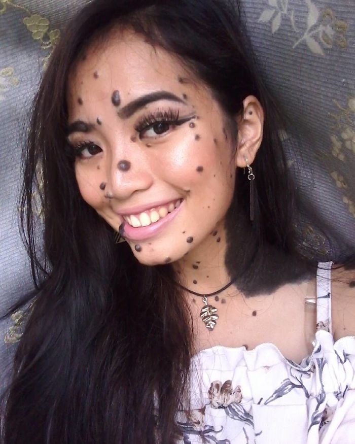 20 Yr Old Girl Bullied For Head To Toe Moles Could Be Crowned Miss